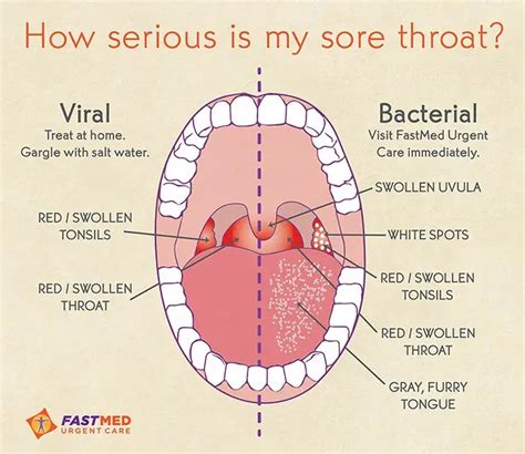 Sore Throat Viral And Bacterial Infections Healthy Food Near Me