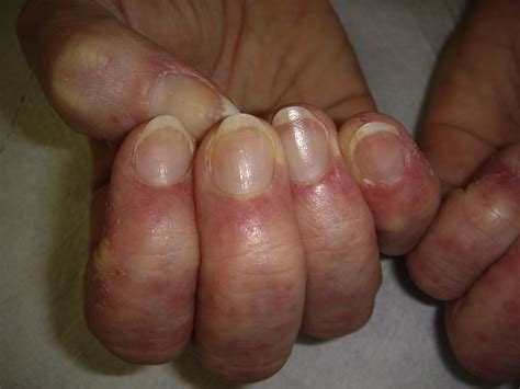 Nail Is Systemic Disorders Main Signs And Clues Dermatologic Clinics