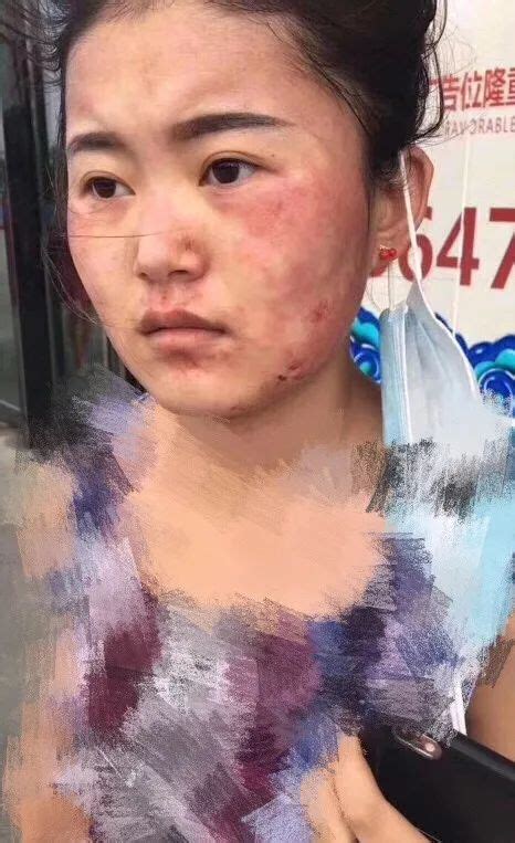 激素脸擦什么产品能好分享我5年激素脸修复经验 哔哩哔哩