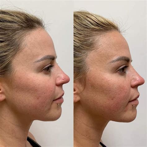 Pdo Threads Before And After Australia At Adrienne Maldonado Blog