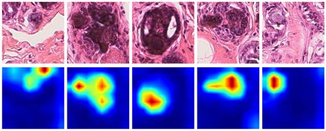 Microcalcification Activation Map On The Top Row Are Presented Patches Download Scientific