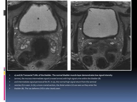 Ppt Bladder Ca Staging Powerpoint Presentation Free Download Id