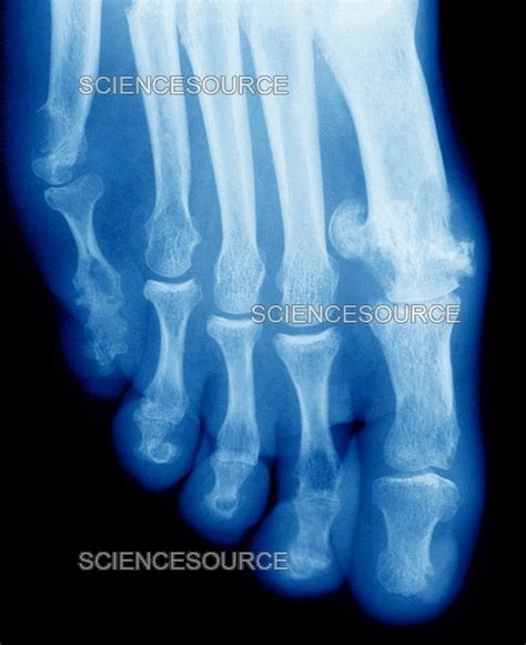 Gout X Ray Radiology