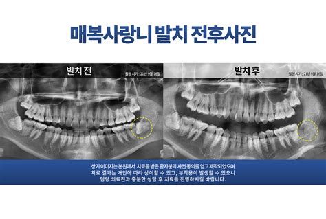 사랑니 발치 1 페이지 최창수치과의원