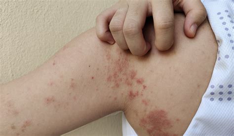 Autoimmune Skin Disorders — Brannata Dermatology