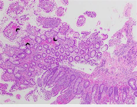 Ileal Mucosa With Expanded Lamina Propria And Multiple Areas Of Download Scientific Diagram