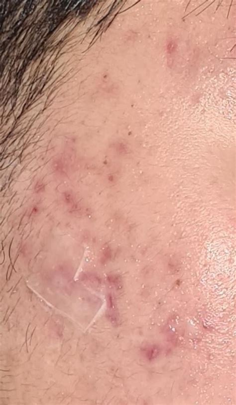 Post Inflammatory Erythema R Ausskincare