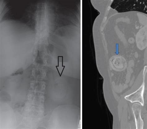 Intussusception X Ray