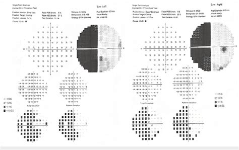 Humphrey Visual Field Hvf Perimetry Showing Left Homonymous Congruous Download Scientific