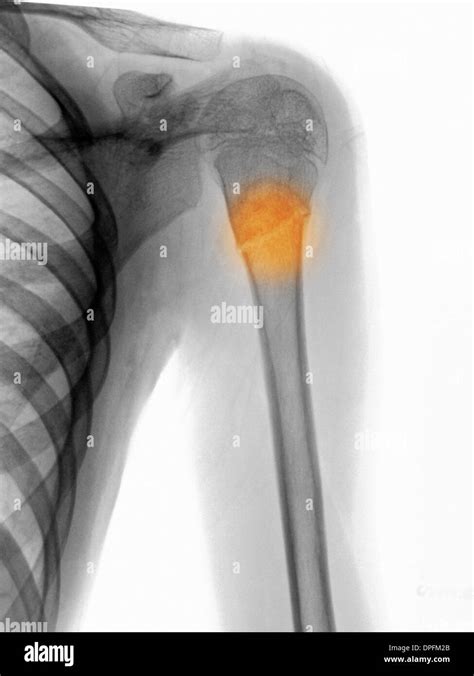 Proximal Humerus Fracture X Ray At James Arechiga Blog
