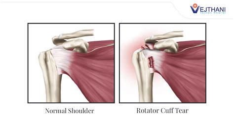 Rotator Cuff Tears Diagnosis Symptoms And Treatment Vrogue