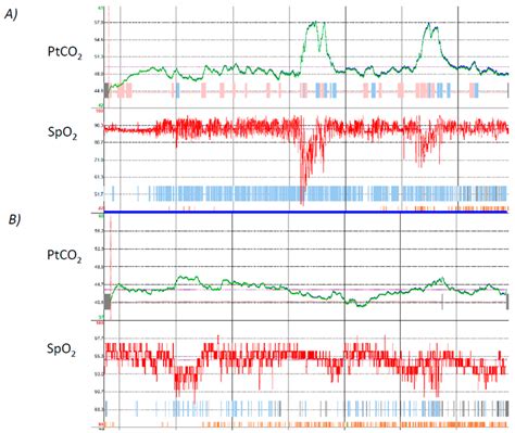 Shows Transcutaneous Monitoring Of A Patient With ALS During Download Scientific Diagram