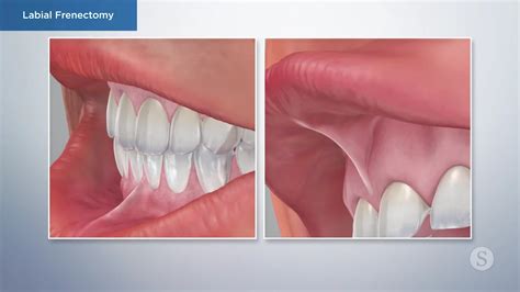 Labial Frenulum Normal