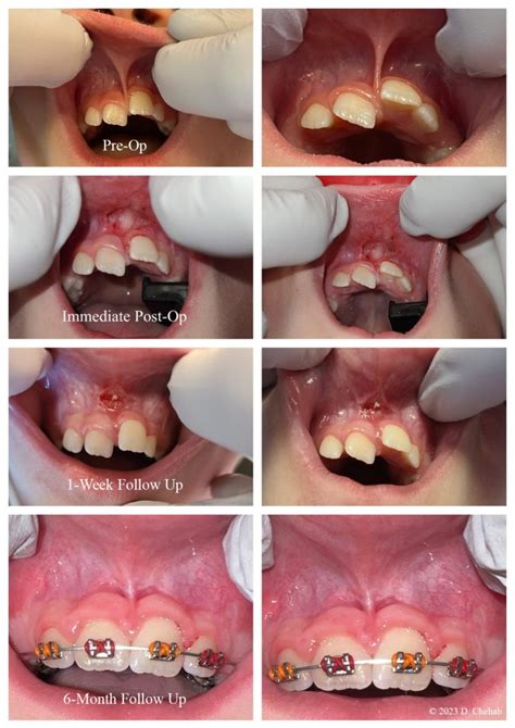 Dr Dina Chehab Performs Successful Lip Tie Release With Lightscalpel
