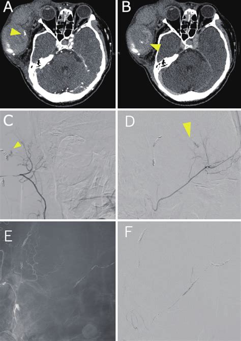 A New Extravascular Leakage Anterior To The Site Of The Previous