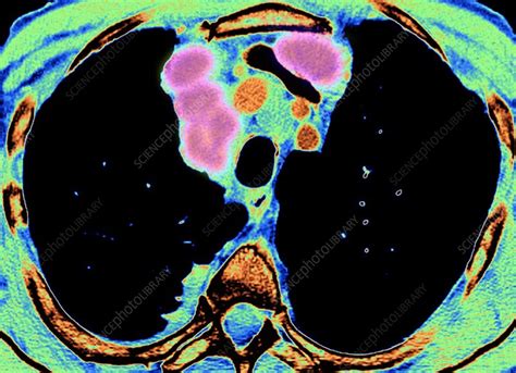 Small Cell Lung Cancer Ct Scan Stock Image C0131079 Science