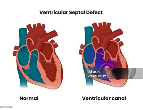 정상적인 심부 해부학을 가진 심실 중격 결함 선천성 심장 결함의 그림 실패에 대한 스톡 벡터 아트 및 기타 이미지 실패 심실 건강관리와 의술 Istock