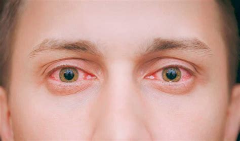 La Queratitis El Diario Bolivia