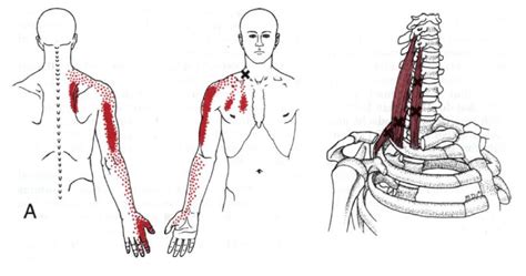 Weightlifting And Trigger Points Scalenes