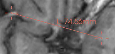 Improve Markups Label Visibility Support 3d Slicer Community