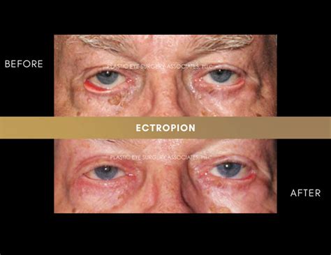 Ectropion