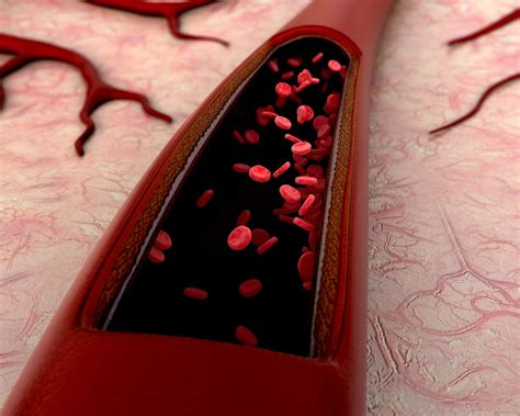 Pulsatile Tinnitus Treatment Hearing Associates Of Las Vegas