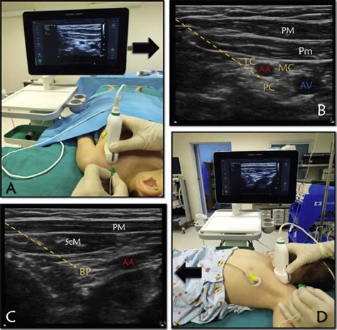 Scielo Brasil Comparison Of The Lateral Sagittal And Costoclavicular Approaches For