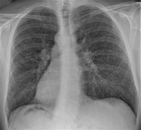 33 Facts About Sarcoidosis