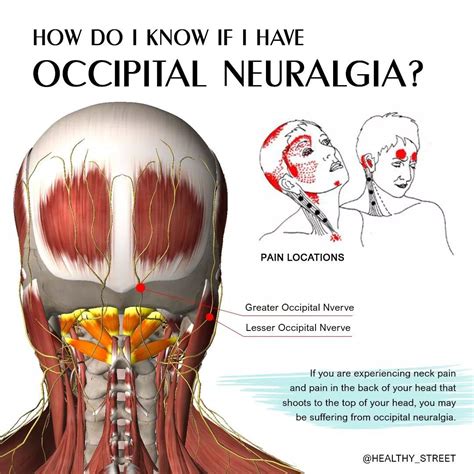 Occipital Nerve Block Injection Artofit