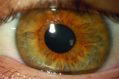 This Is A Figure Of A Patient With Kayser Fleischer Ring White Arrow Download Scientific