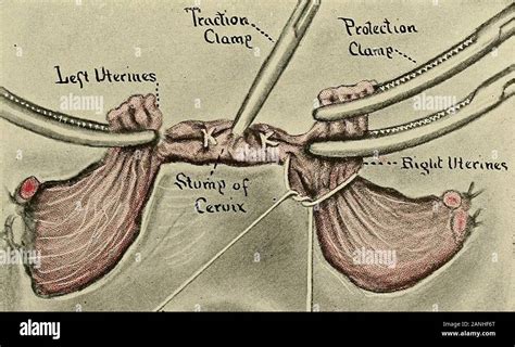 Gynecology Fig 324 —supravaginal Hysterectomy The Uterus Has Been