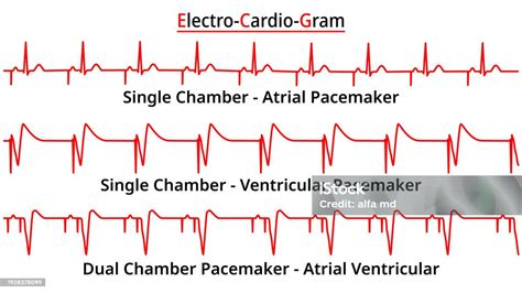 Set Of Ecg Common Abnormalities Single Vs Dual Chamber Pacemaker Atrial Ventricular Rhythm Stock