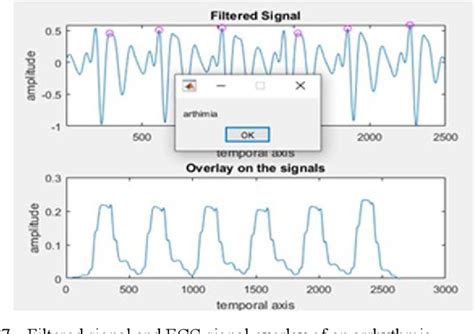 Figure 7 From Multi Layered Cardiac Arrhythmia Detection Using Rmse Method Semantic Scholar