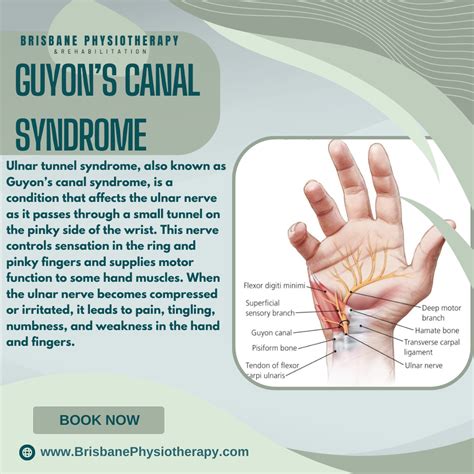 What Is Guyons Canal Syndrome Brisbane Physiotherapy