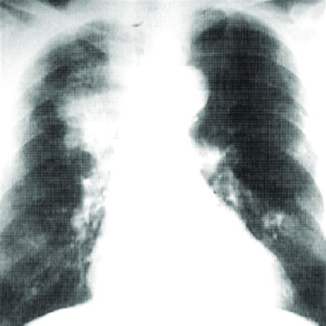 Ct Scan Shows The Nodular Lesion In The Lingular Segment Of The Left Download Scientific