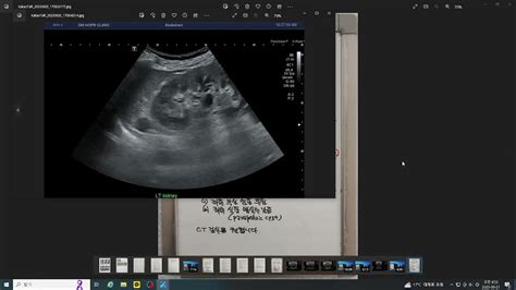 알초사 초음파 증례송필훈 2023년9월20일 좌측 부신 선종 65세 Youtube