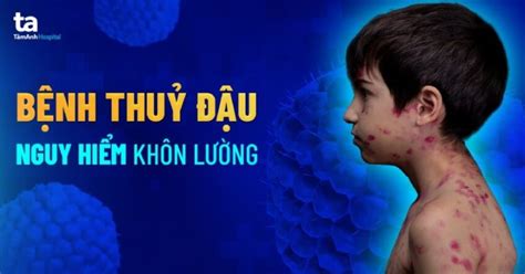 Bệnh thủy đậu Dấu hiệu nguyên nhân và cách chẩn đoán