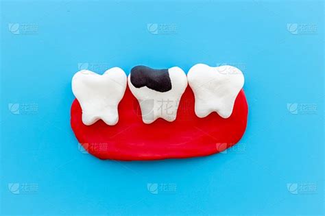 牙齿健康和牙科保健。有龋齿或牙斑的模型素材 花瓣网