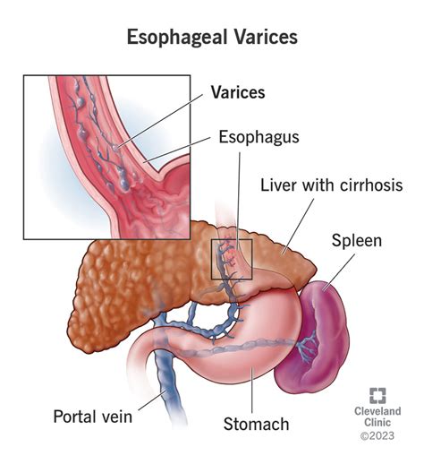 Esophageal Varices Symptoms Causes And Treatment
