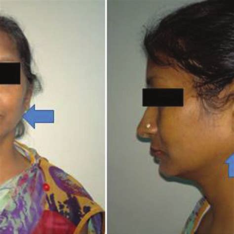 Figuur Beeld Na Transurethrale Resectie Download Scientific Diagram