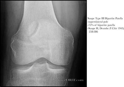 Bipartite Patella Q EORIF