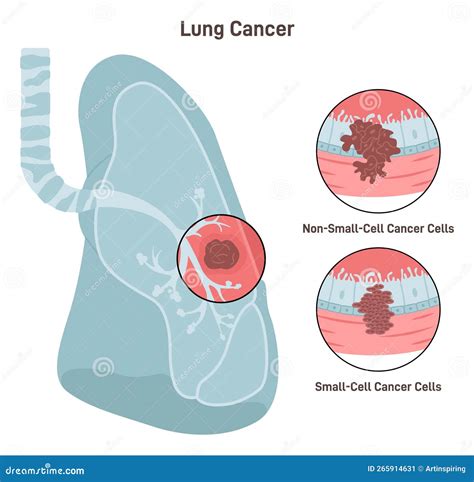Bronchial Cancer Pathological Malignant Cells Or Tumor Located Vector
