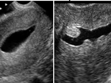 Fertility Test Hysterosonogram At Cristal Lawrence Blog