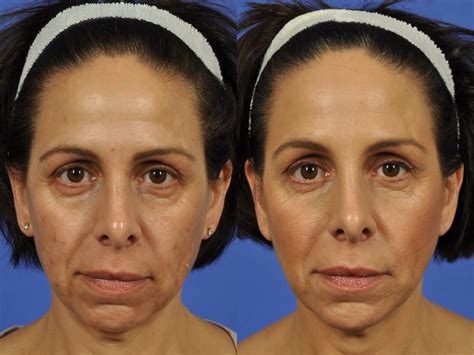 Tear Trough Filler Before And After Photos W Cosmetic Surgery