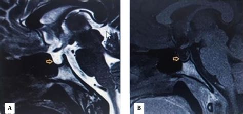 Mri Brain Yellow Arrow Showing Empty Sella A T2 Weighted B T1 Download Scientific Diagram