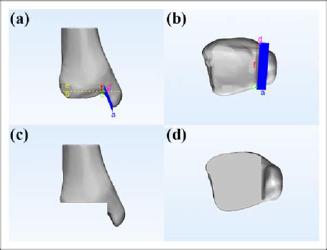 Distal Tibial Resection Was Done On The Reconstruction Model A