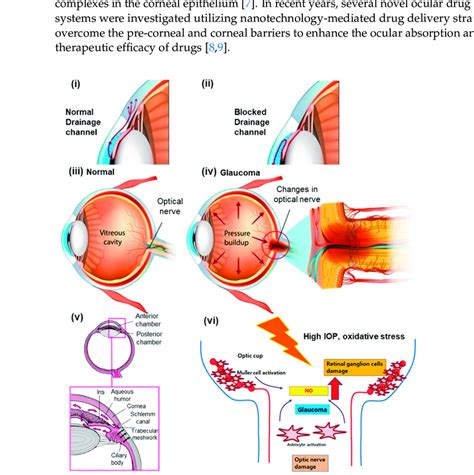 Glaucoma Eye Structure At Sharon Alexander Blog