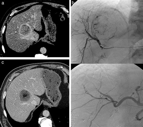 Transarterial Chemoembolization For Hepatocellular Carcinoma With Download Scientific Diagram
