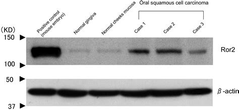 Ror2 Expression In Squamous Cell Carcinoma And Epithelial Dysplasia Of