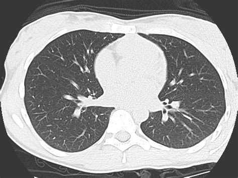 Contraceptive Implant Embolization Image Radiopaedia Org